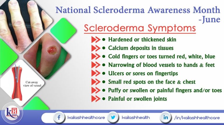 National Scleroderma Awareness Month – June